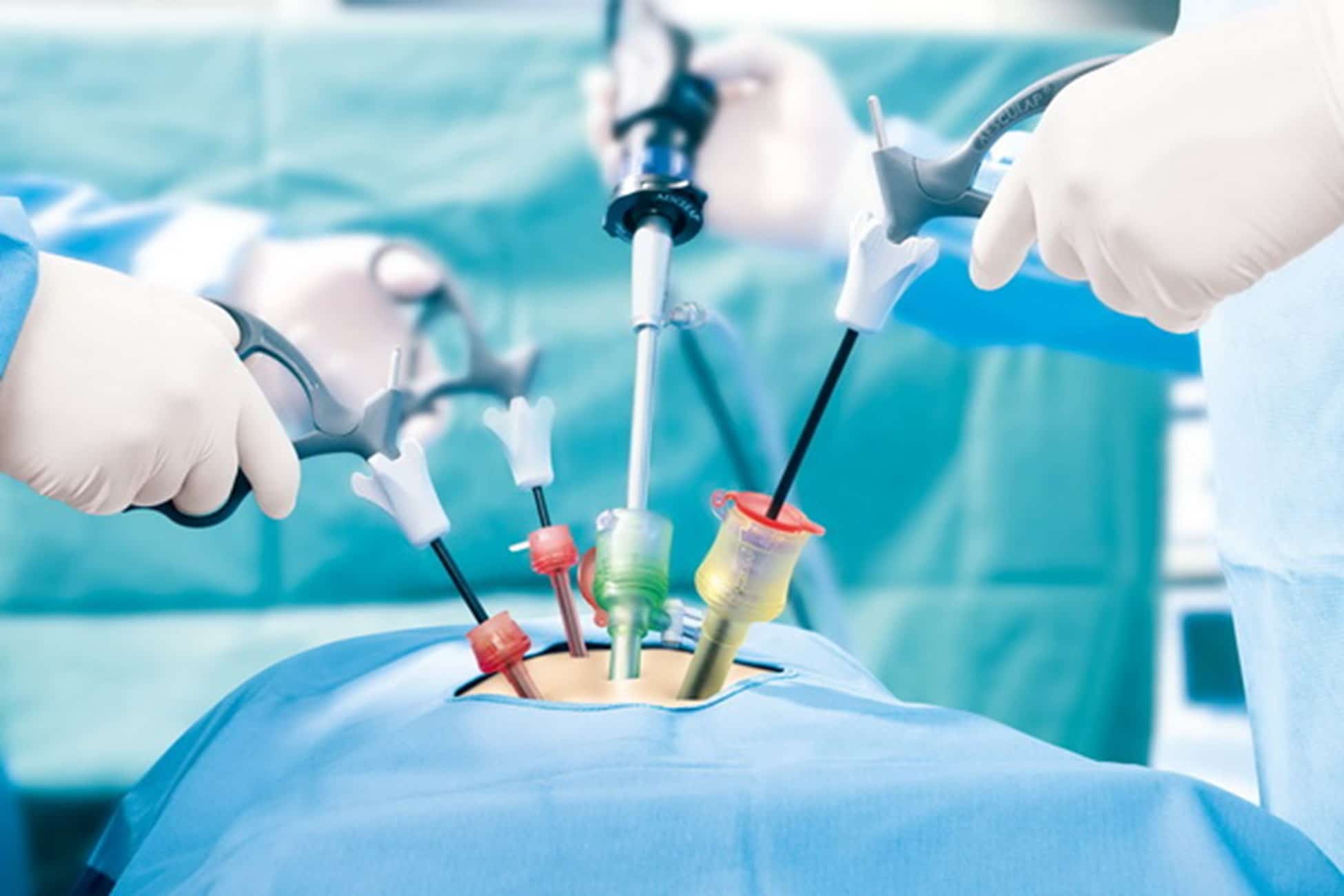 Laparoscopic Cholecystectomy And Appendectomy Bangalore